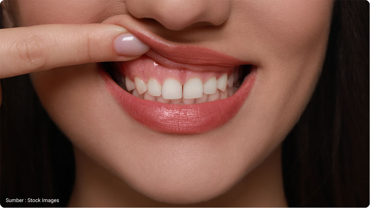 Gum Treatment Mudah dan Lengkap di BSD: Signature Dental Care ...